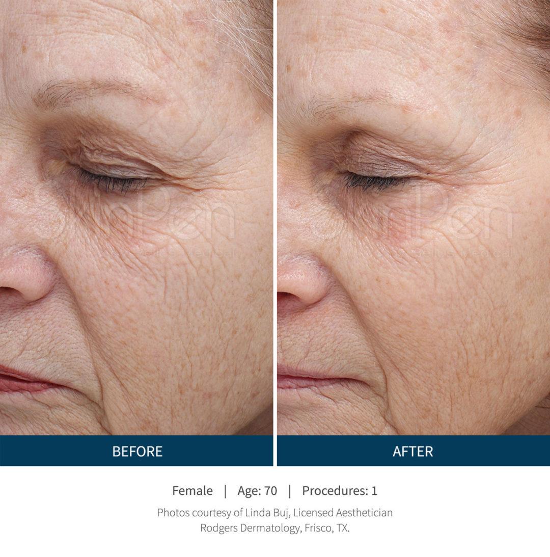 Microneedling - Dermatologist in South Florida