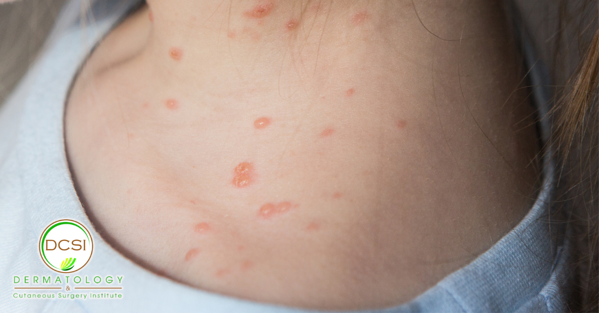 What You Need to Know About Chickenpox | DCSI
