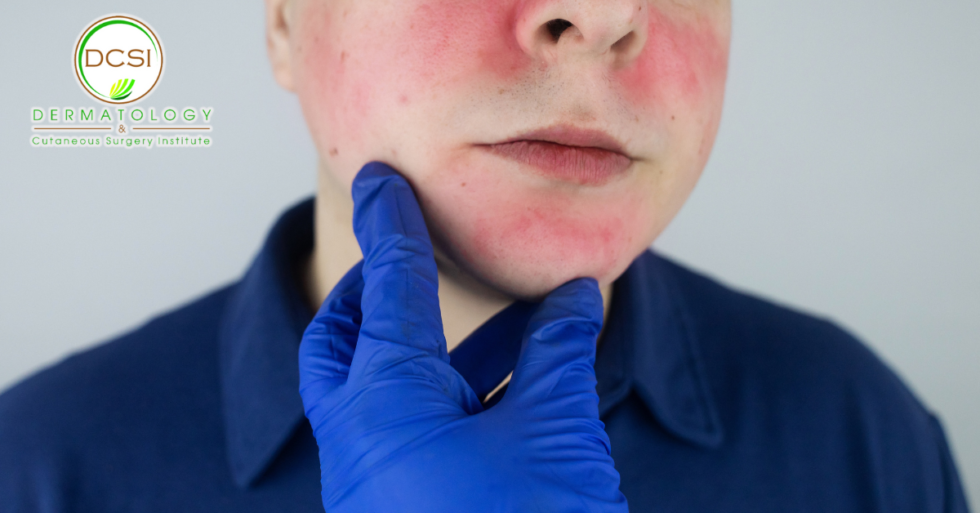 Rosacea Treatment and Management | DCSI Florida Dermatology