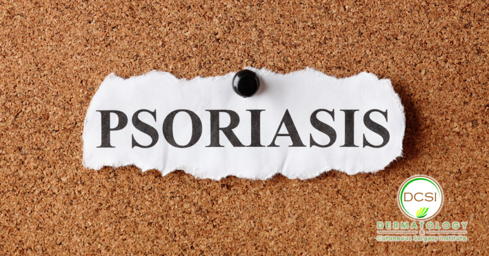 Treating Psoriasis With Expert Care and Advice | DCSI