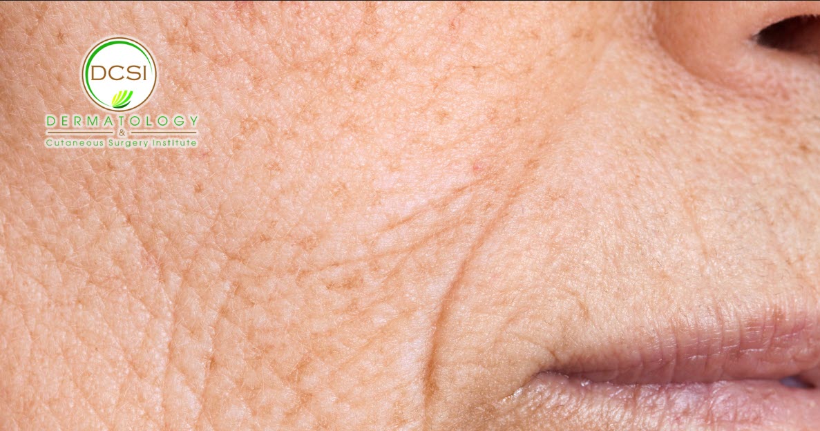 Wrinkle Prevention Tips | DCSI Dermatology
