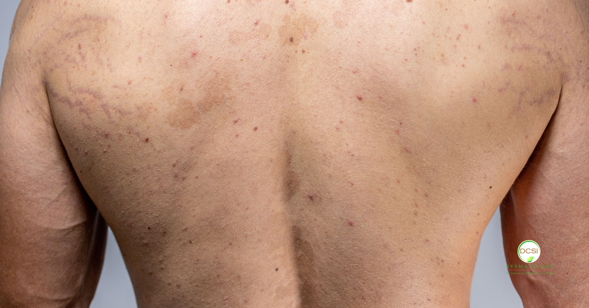 Pityriasis Rosea: Rash Symptoms, Diagnosis & Treatment | DCSI